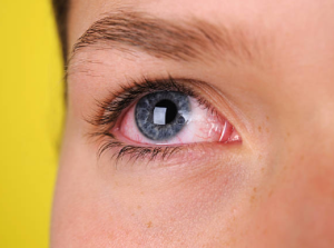 Gamot sa Sore Eyes Over the Counter - Gamot ng Sakit