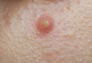 Gamot sa Pigsa na Ointment - Gamot ng Sakit