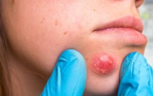 Gamot sa Pigsa na Walang Mata - Gamot ng Sakit