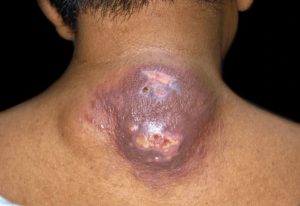 Cloxacillin gamot para sa Pigsa - Gamot ng Sakit