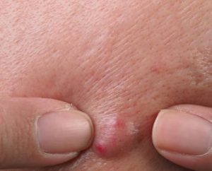 Gamot sa Pigsa na Home remedy- 10 Halimbawa - Gamot ng Sakit